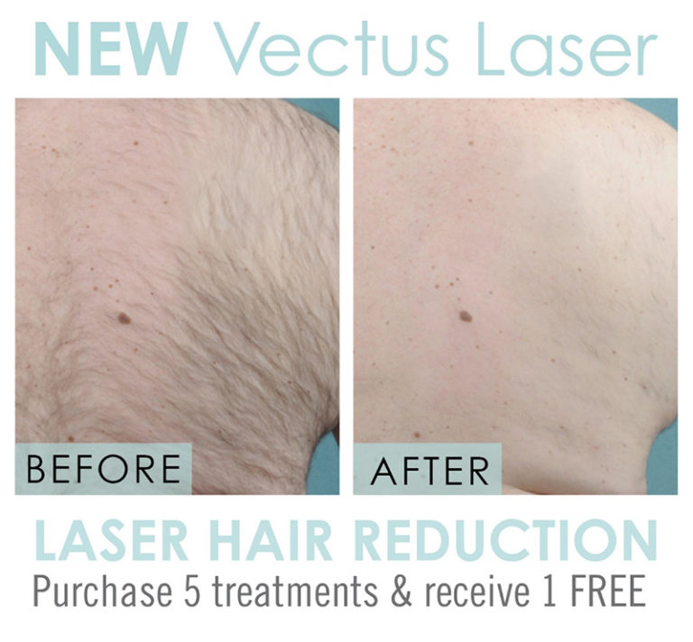 4 Reasons Your Should Try Vectus Laser Hair Removal
