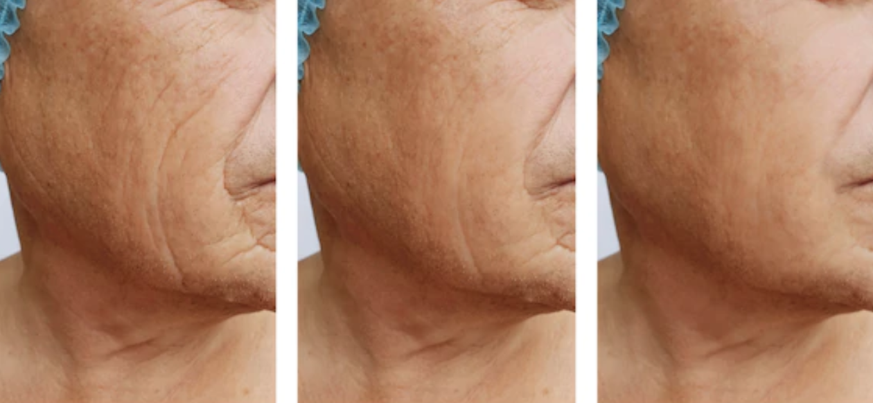 Icon 1540 Fractional Non-Ablative - Men's Contemporary Health Center