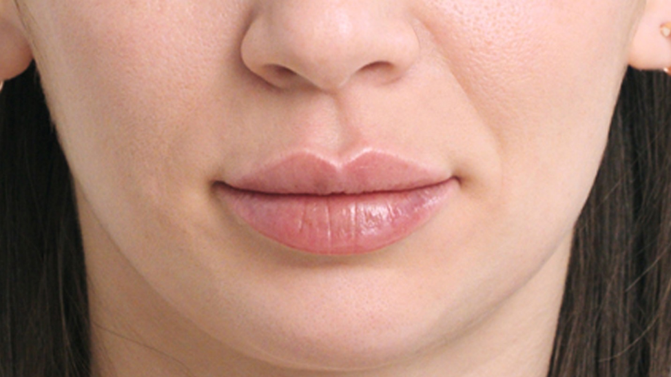 Everything to Know About Restylane Kysse, the New, Longer-Lasting Lip ...