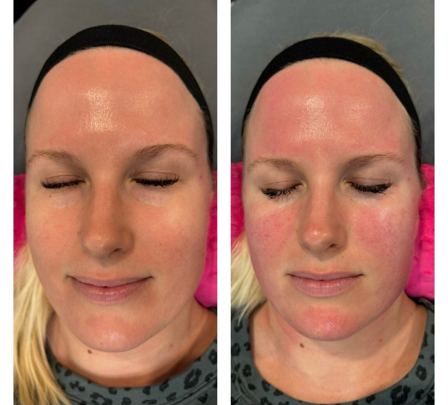 Skinwave Hydrofacial - Men's Contemporary Health Center